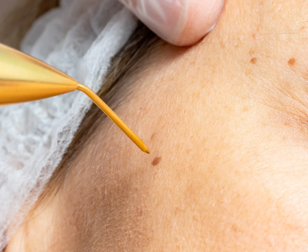 Removing Skin Tags Moles, Skin Tags & Skin Lumps Laser Skin Care